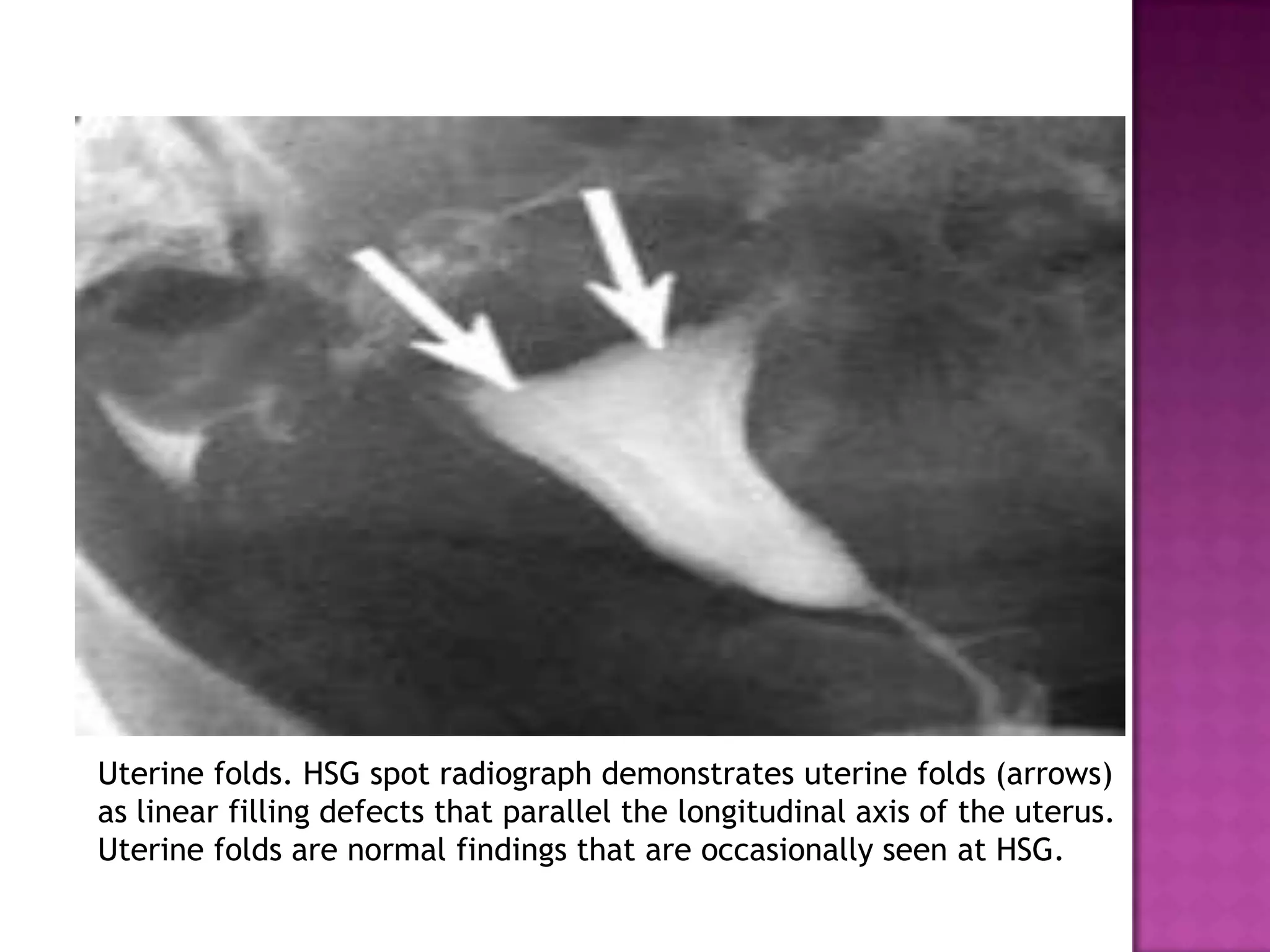 Hysterosalpingography | PPTX