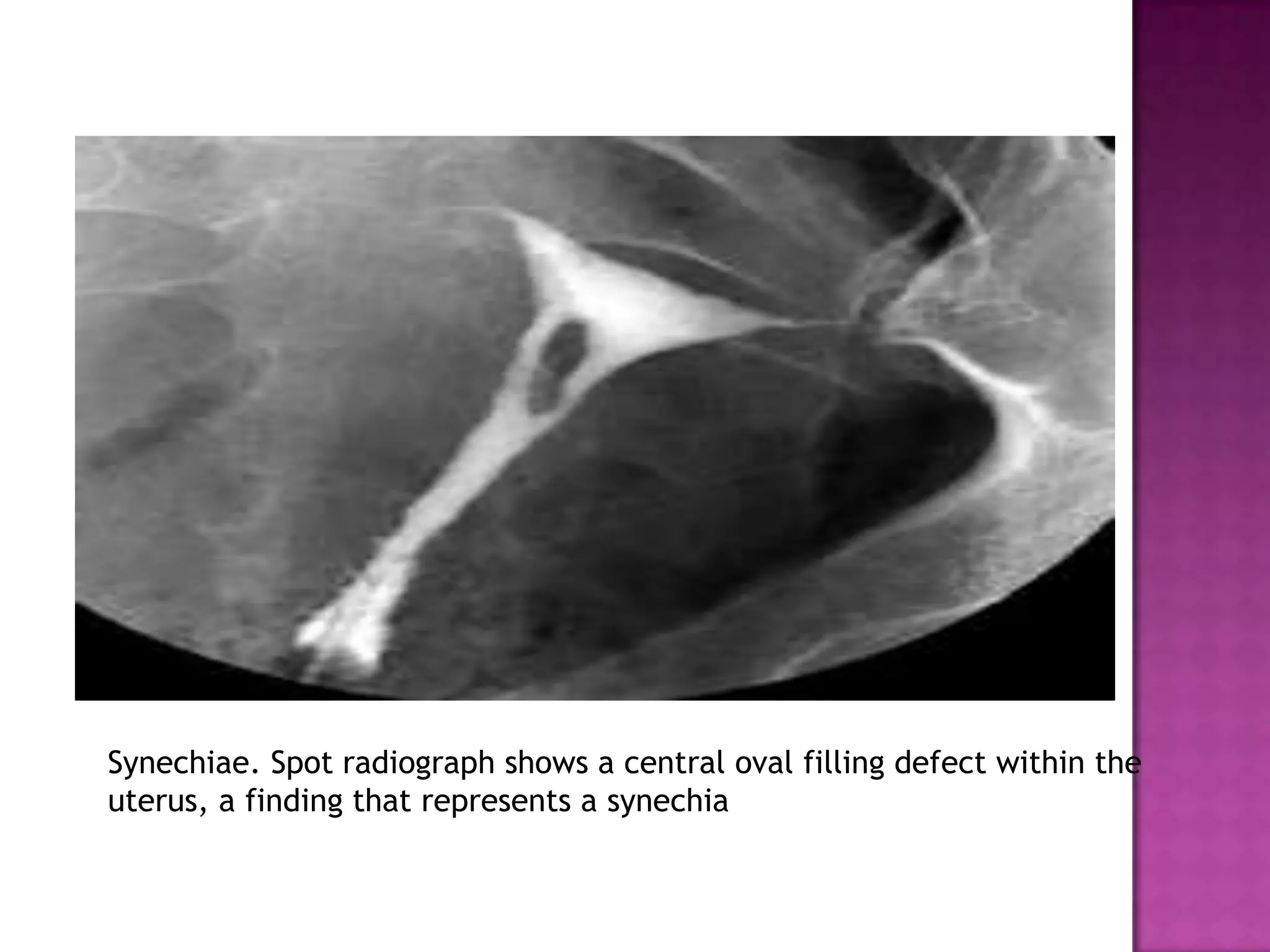 Hysterosalpingography | PPTX
