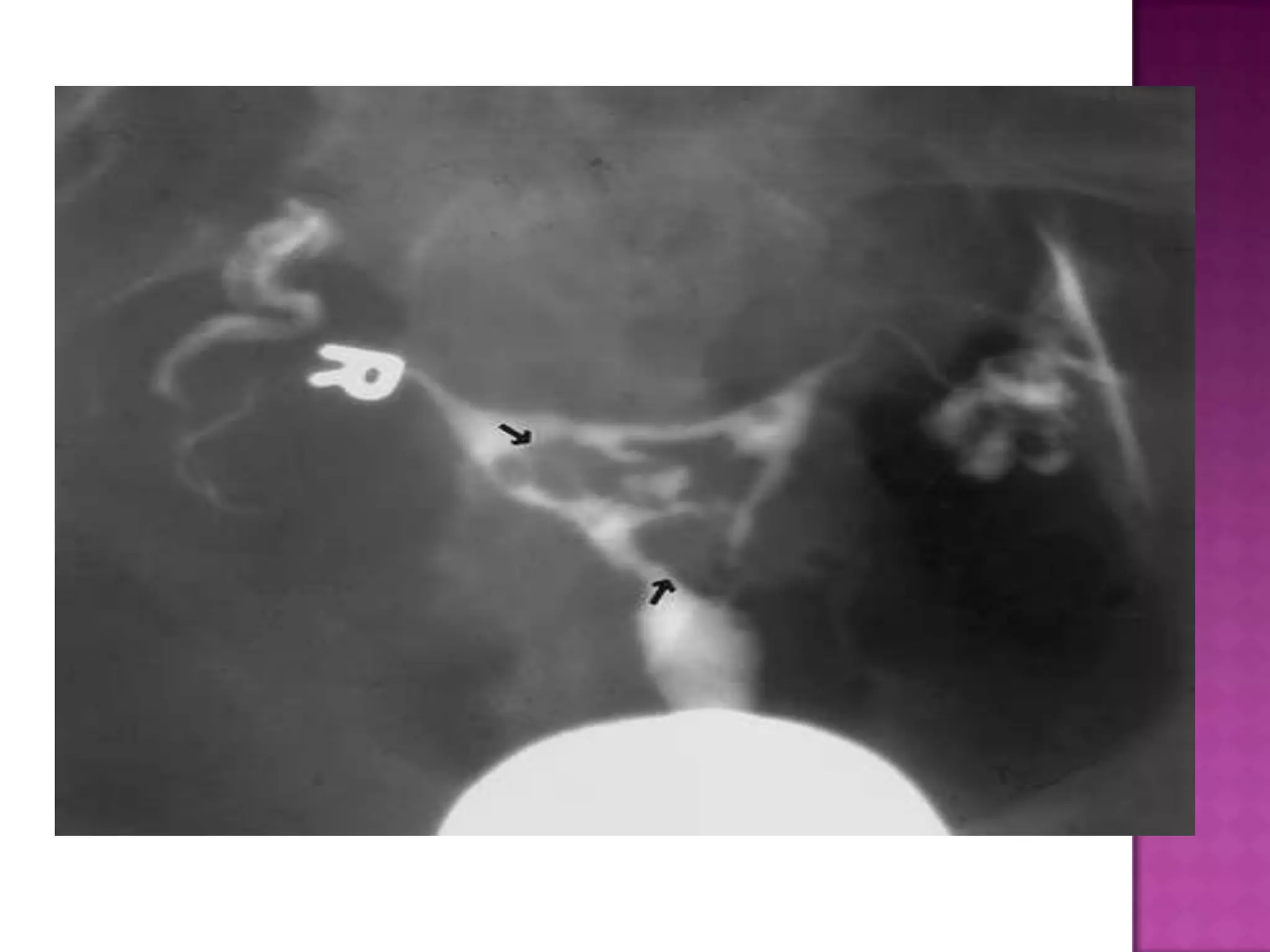 Hysterosalpingography | PPTX