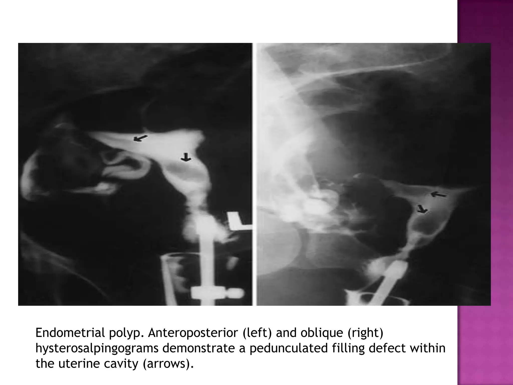 Hysterosalpingography | PPTX