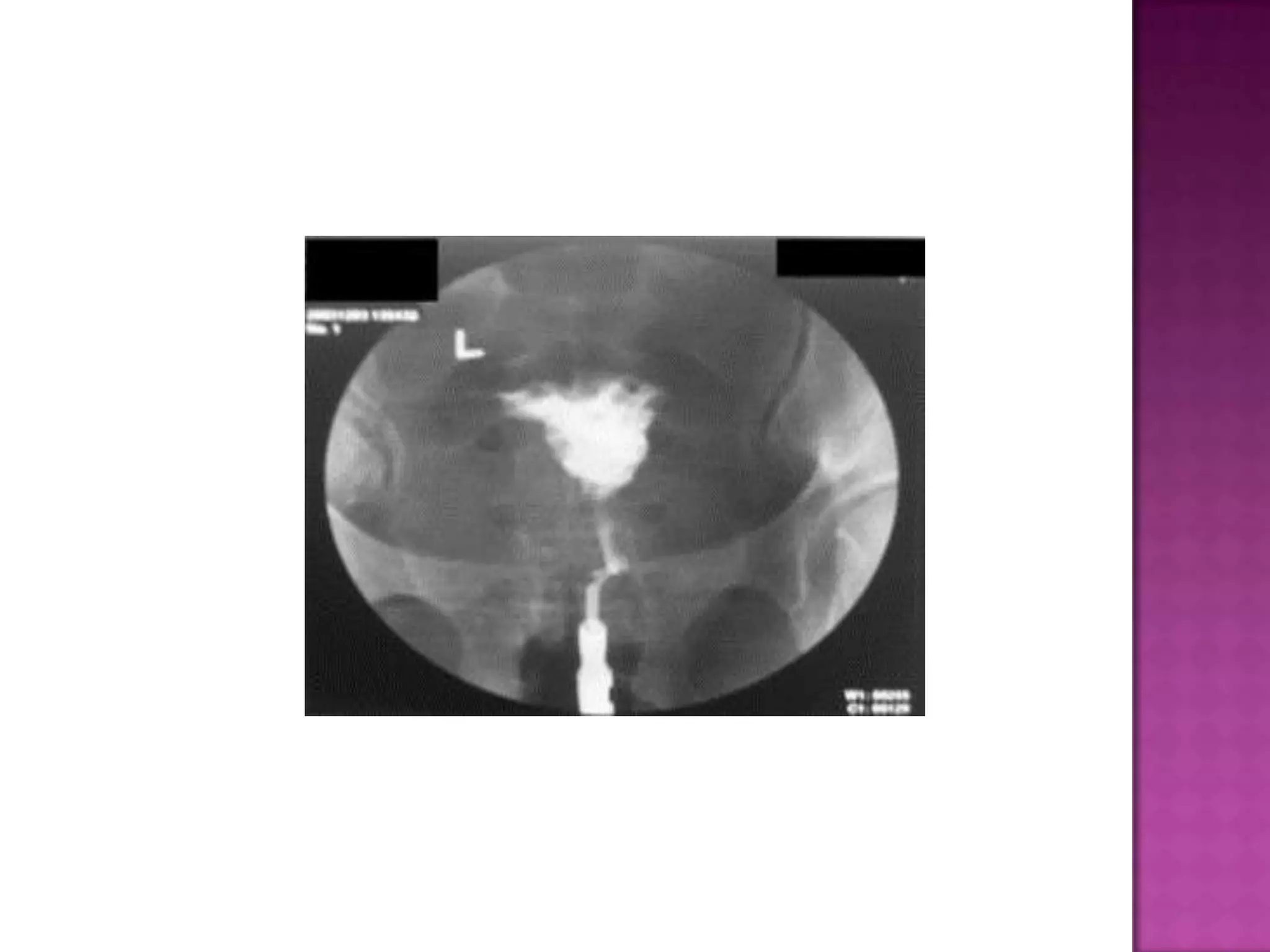 Hysterosalpingography | PPTX