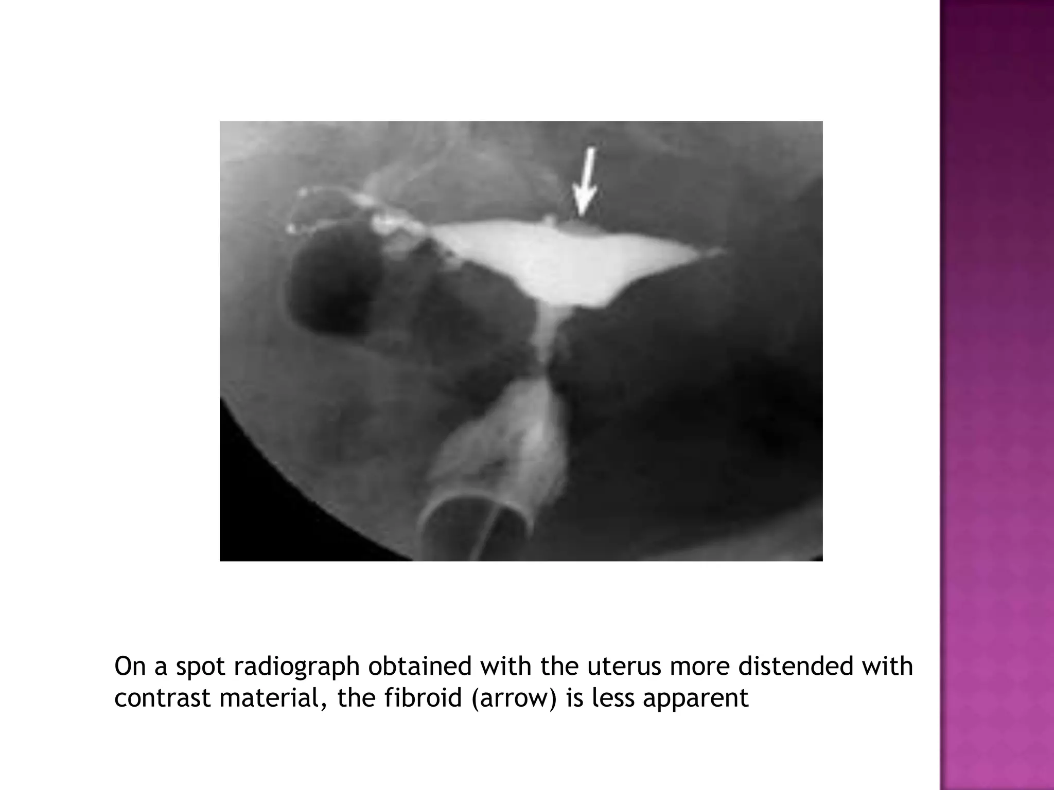 Hysterosalpingography | PPTX