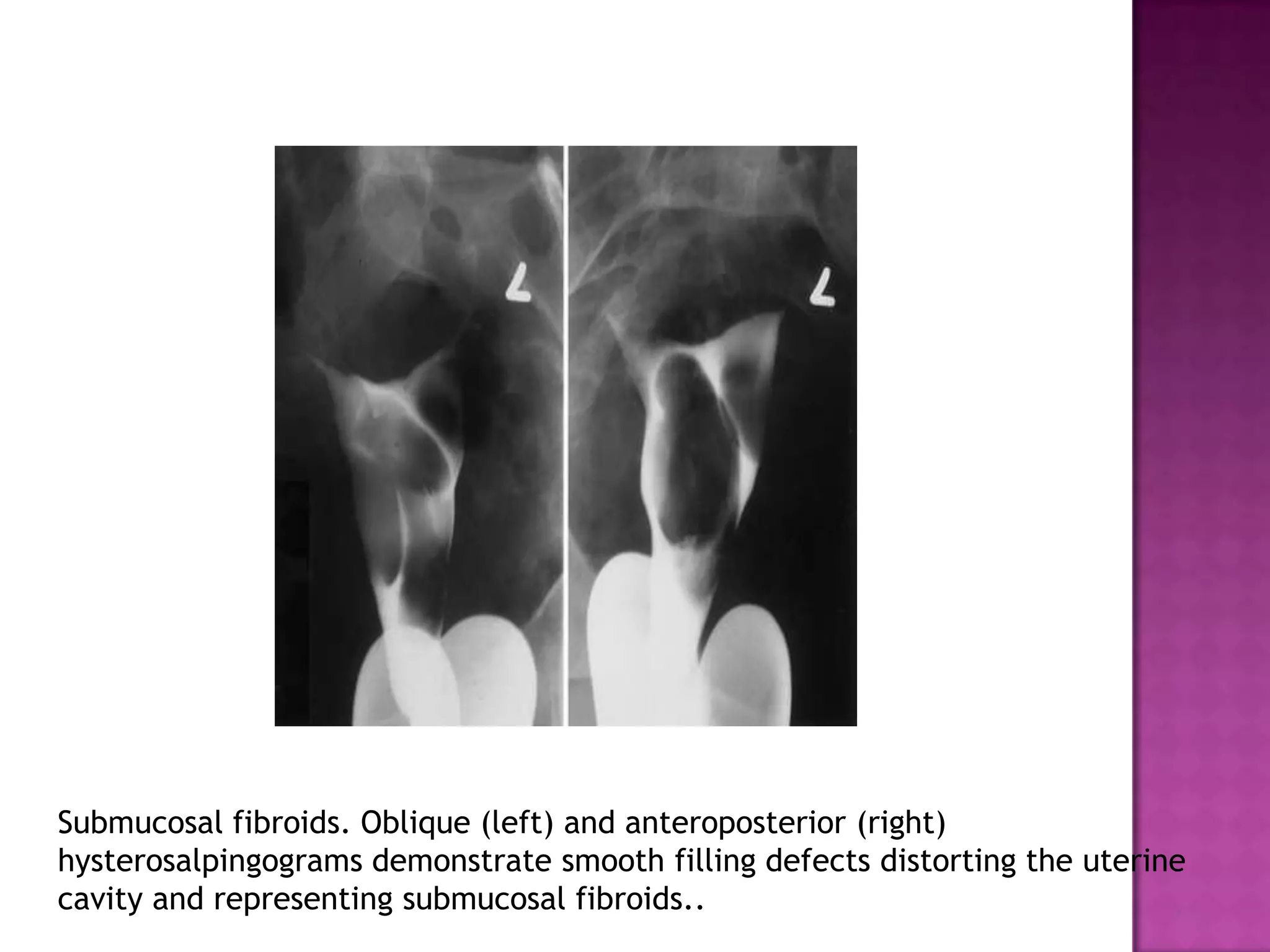 Hysterosalpingography | PPTX