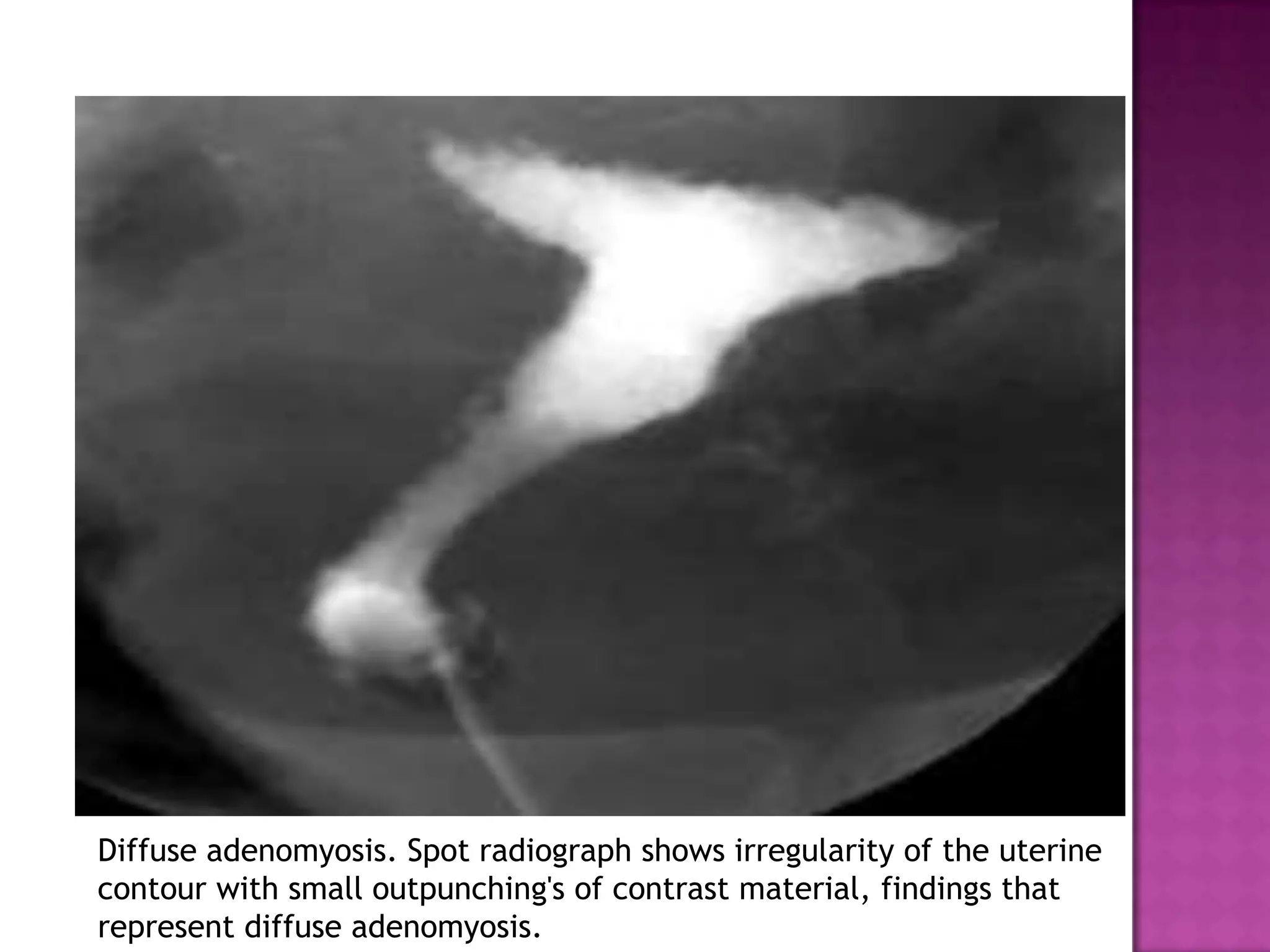 Hysterosalpingography | PPTX