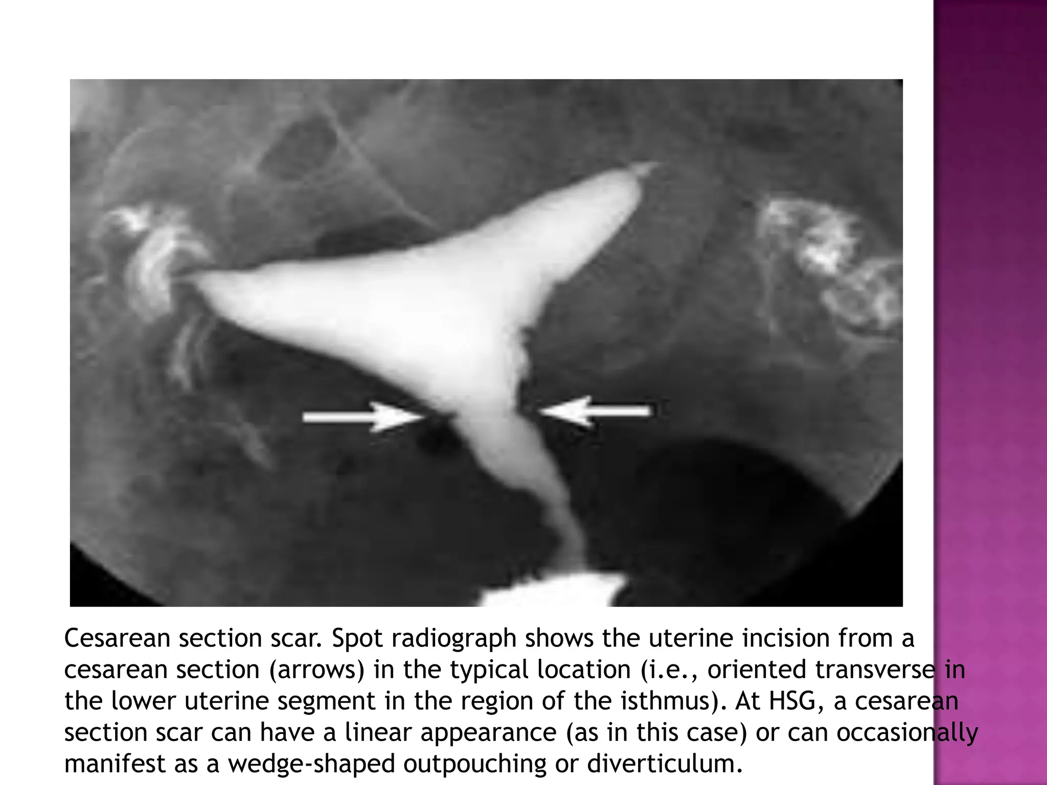 Hysterosalpingography | PPTX