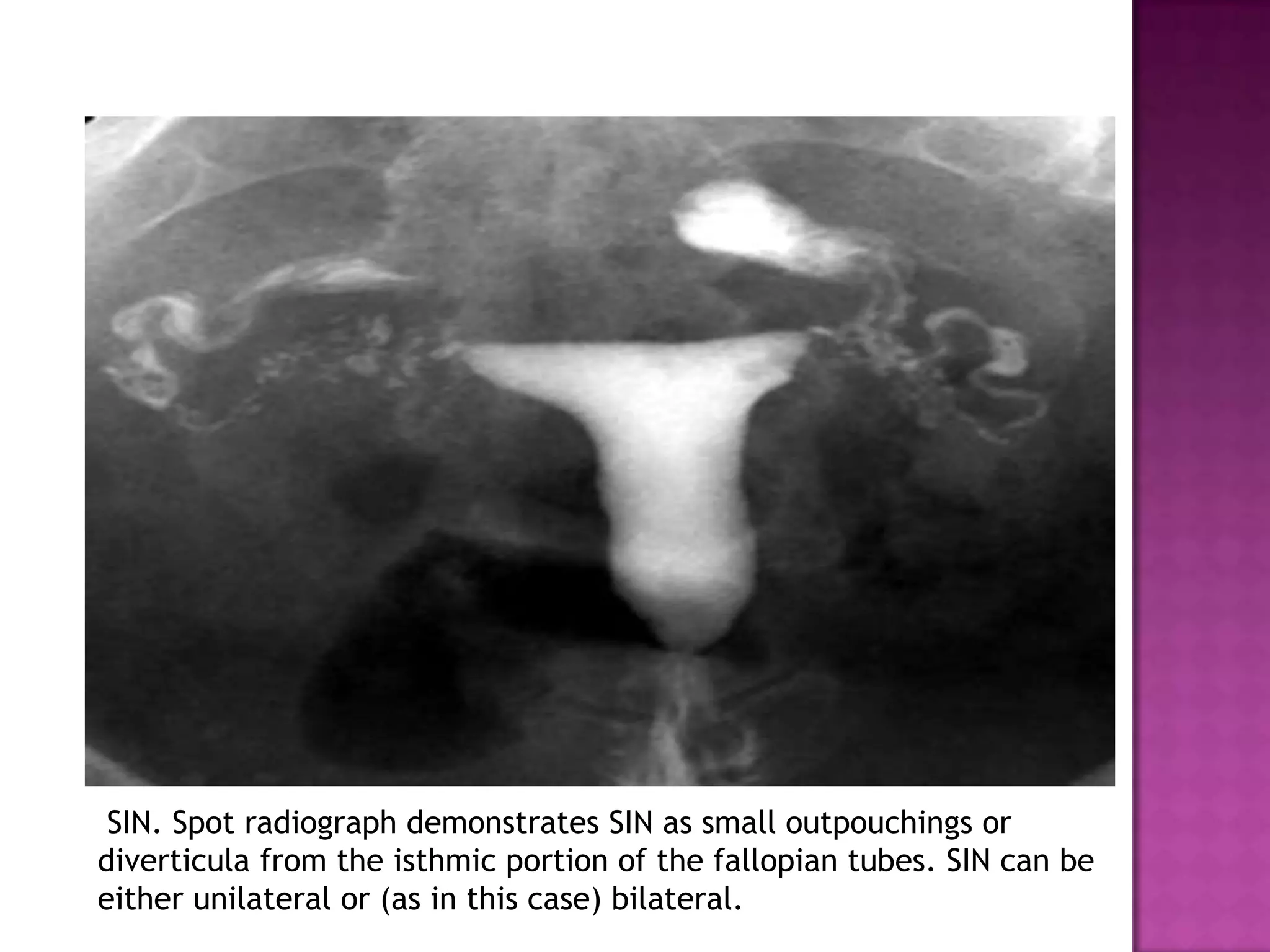 Hysterosalpingography | PPTX