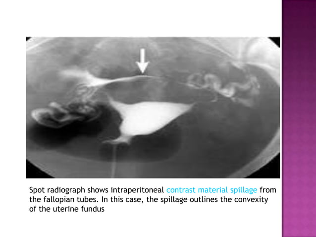 Hysterosalpingography | PPTX | Pregnancy | Reproductive Health