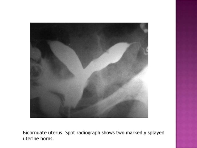 Hysterosalpingography | PPTX | Pregnancy | Reproductive Health