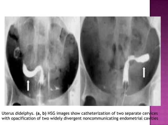 Hysterosalpingography | PPTX | Pregnancy | Reproductive Health