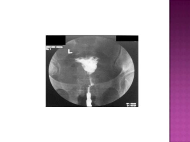 Hysterosalpingography | PPTX | Pregnancy | Reproductive Health