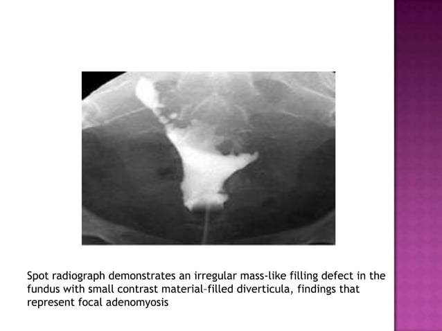 Hysterosalpingography | PPTX | Pregnancy | Reproductive Health