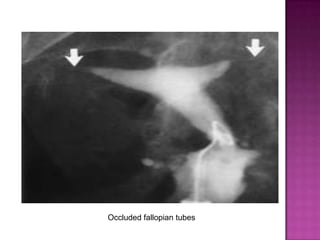 Hysterosalpingography | PPTX