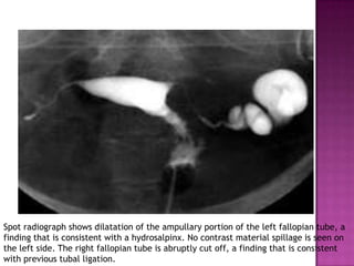 Hysterosalpingography | PPTX