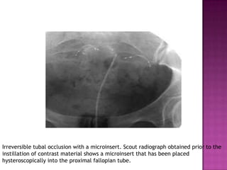 Hysterosalpingography | PPTX