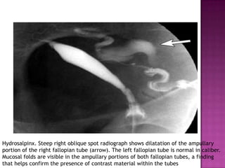 Fallopian Tube Anatomy Hsg