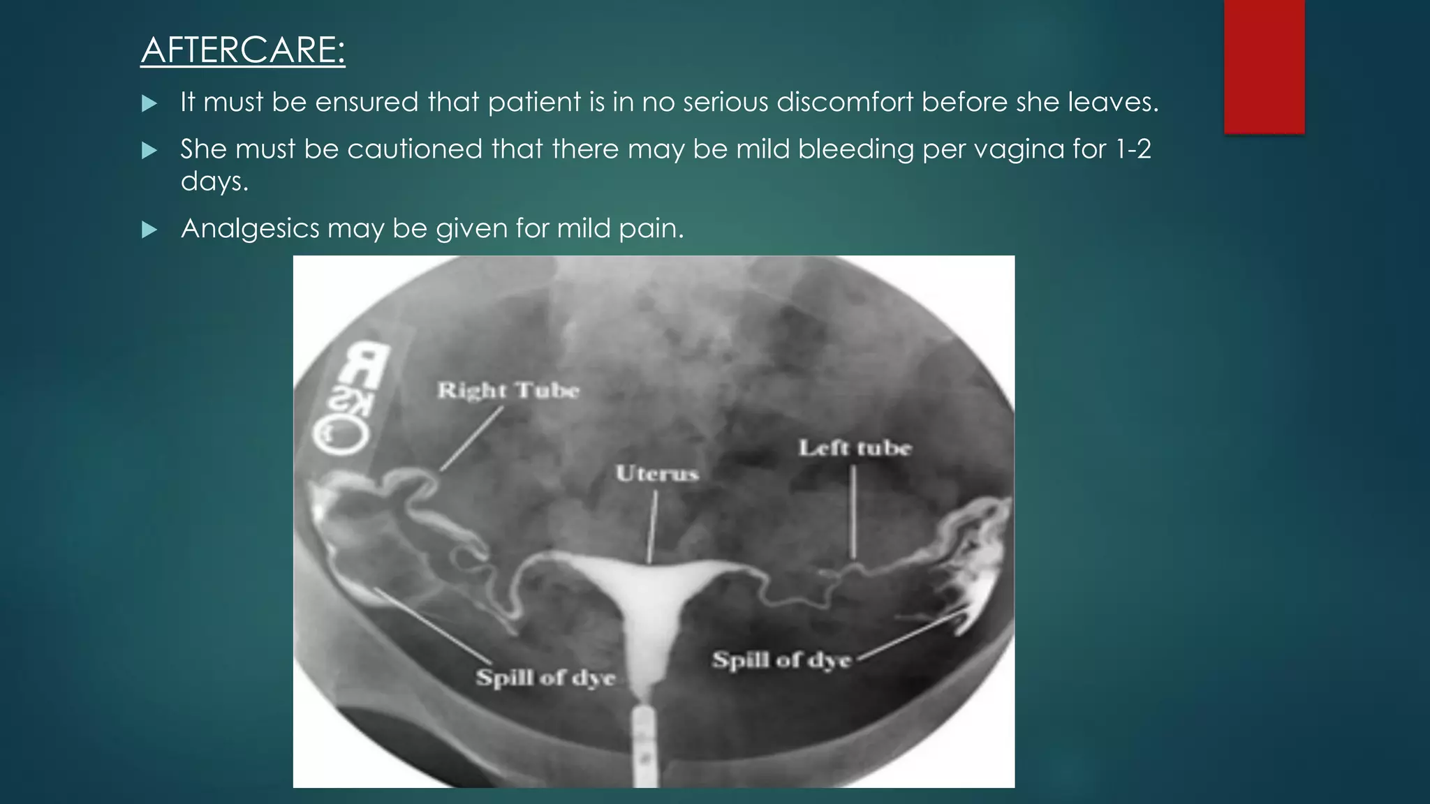 Hysterosalpingography.pdf