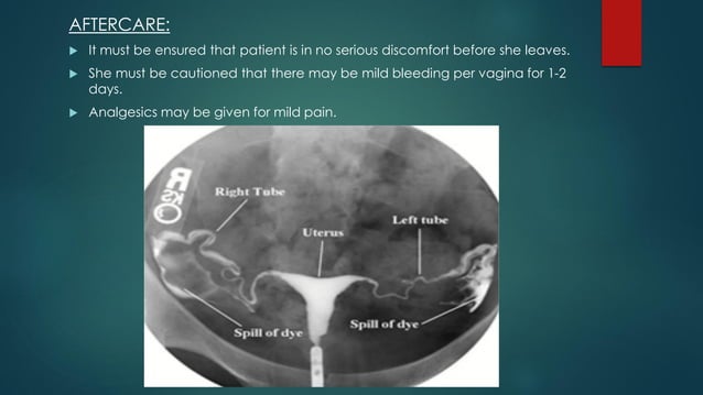 Hysterosalpingography.pdf