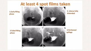 Hysterosalpingography; therapeutic and diagnostic approach | PDF