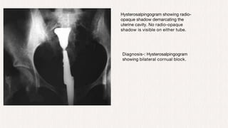Hysterosalpingography; therapeutic and diagnostic approach | PDF