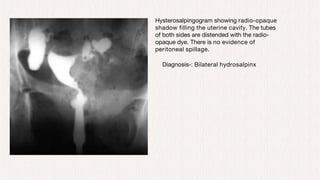 Hysterosalpingography; therapeutic and diagnostic approach | PDF