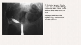 Hysterosalpingography; therapeutic and diagnostic approach | PDF