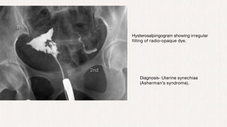 Hysterosalpingography; therapeutic and diagnostic approach | PDF