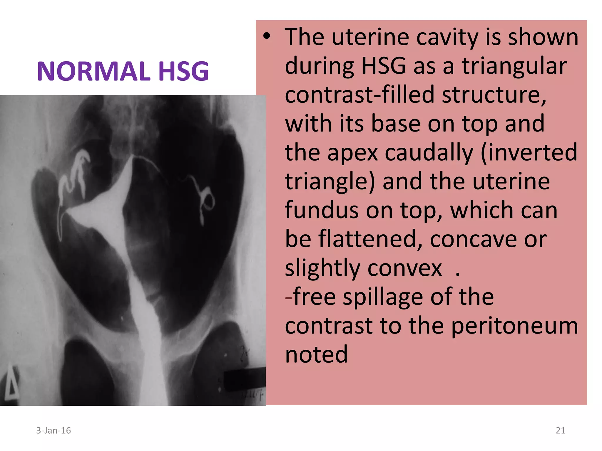 Hysterosalpingography | PPTX