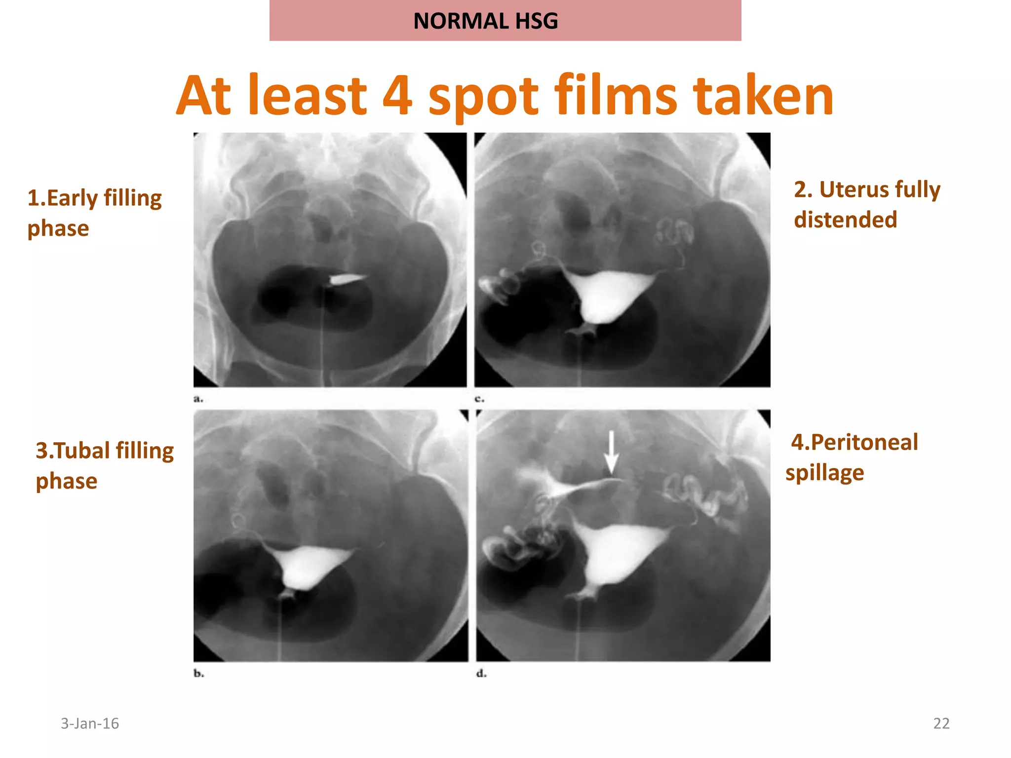 Hysterosalpingography | PPTX
