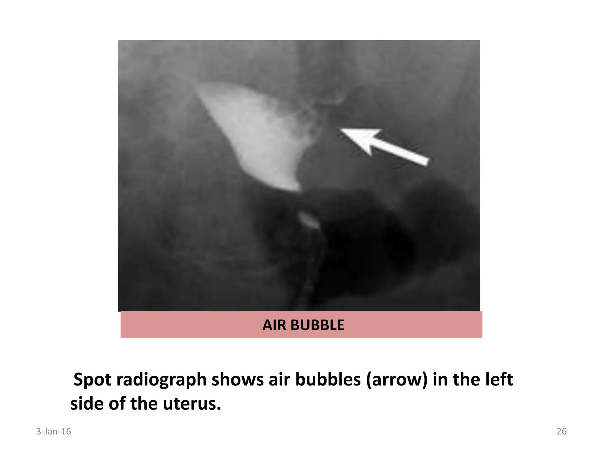 Hysterosalpingography | PPTX