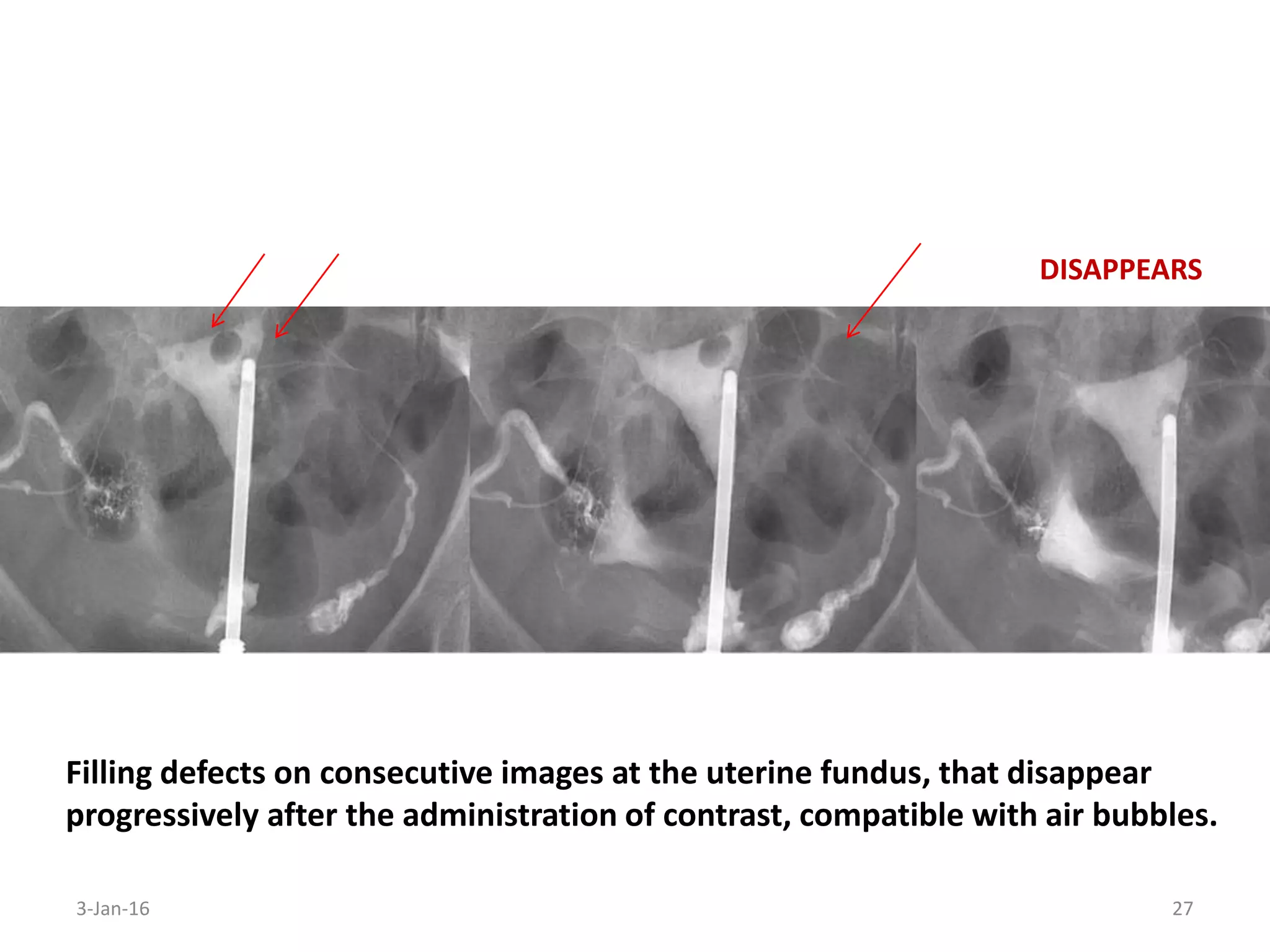 Hysterosalpingography | PPTX