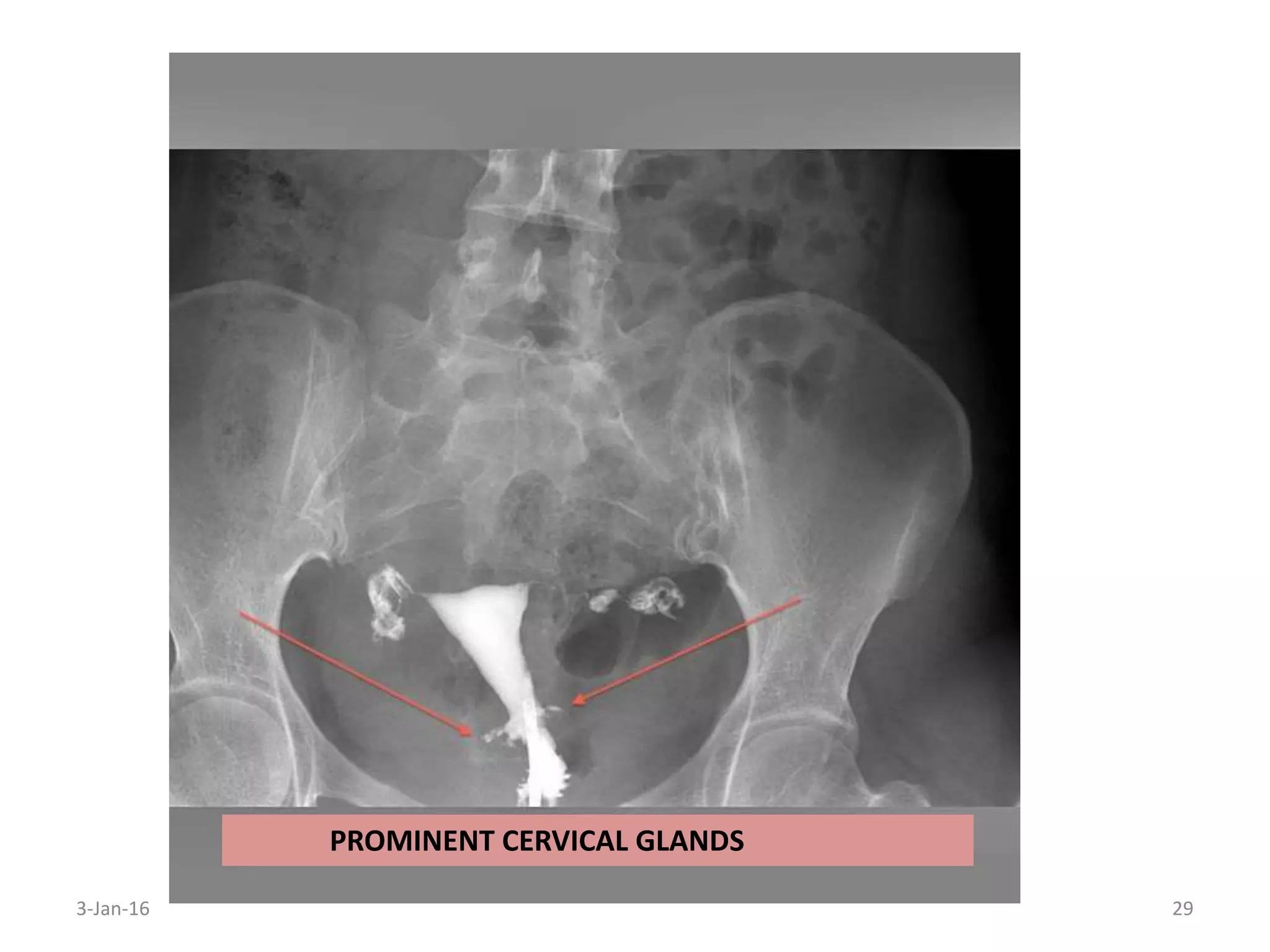 Hysterosalpingography | PPTX