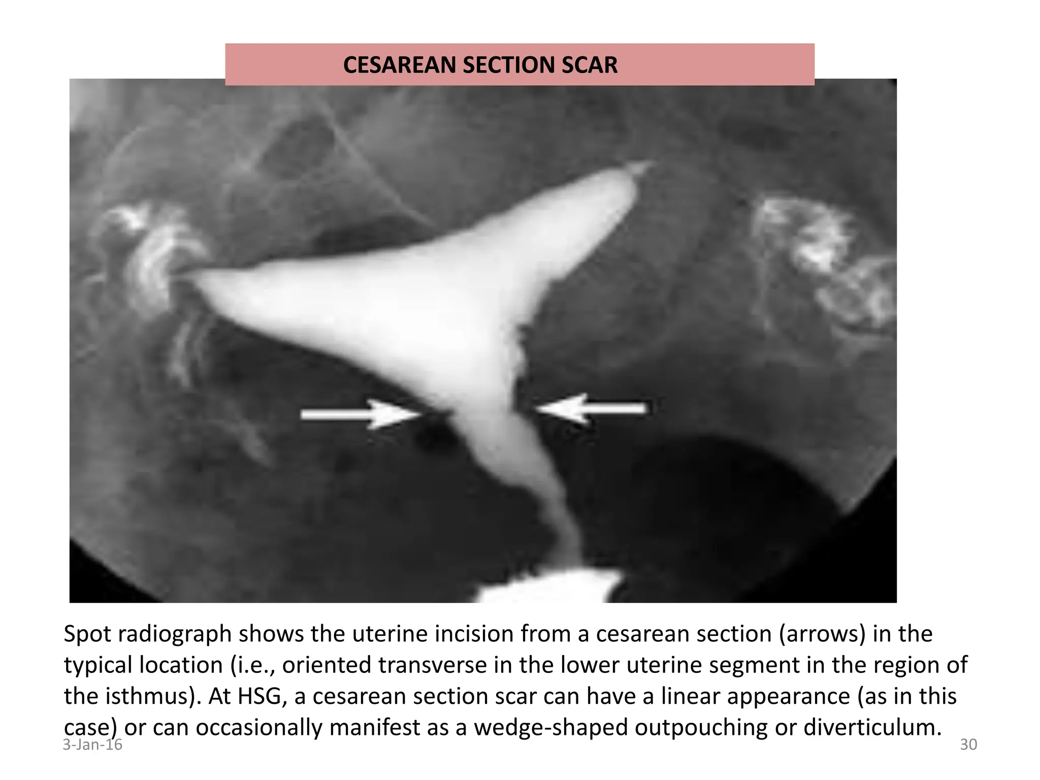 Hysterosalpingography | PPTX