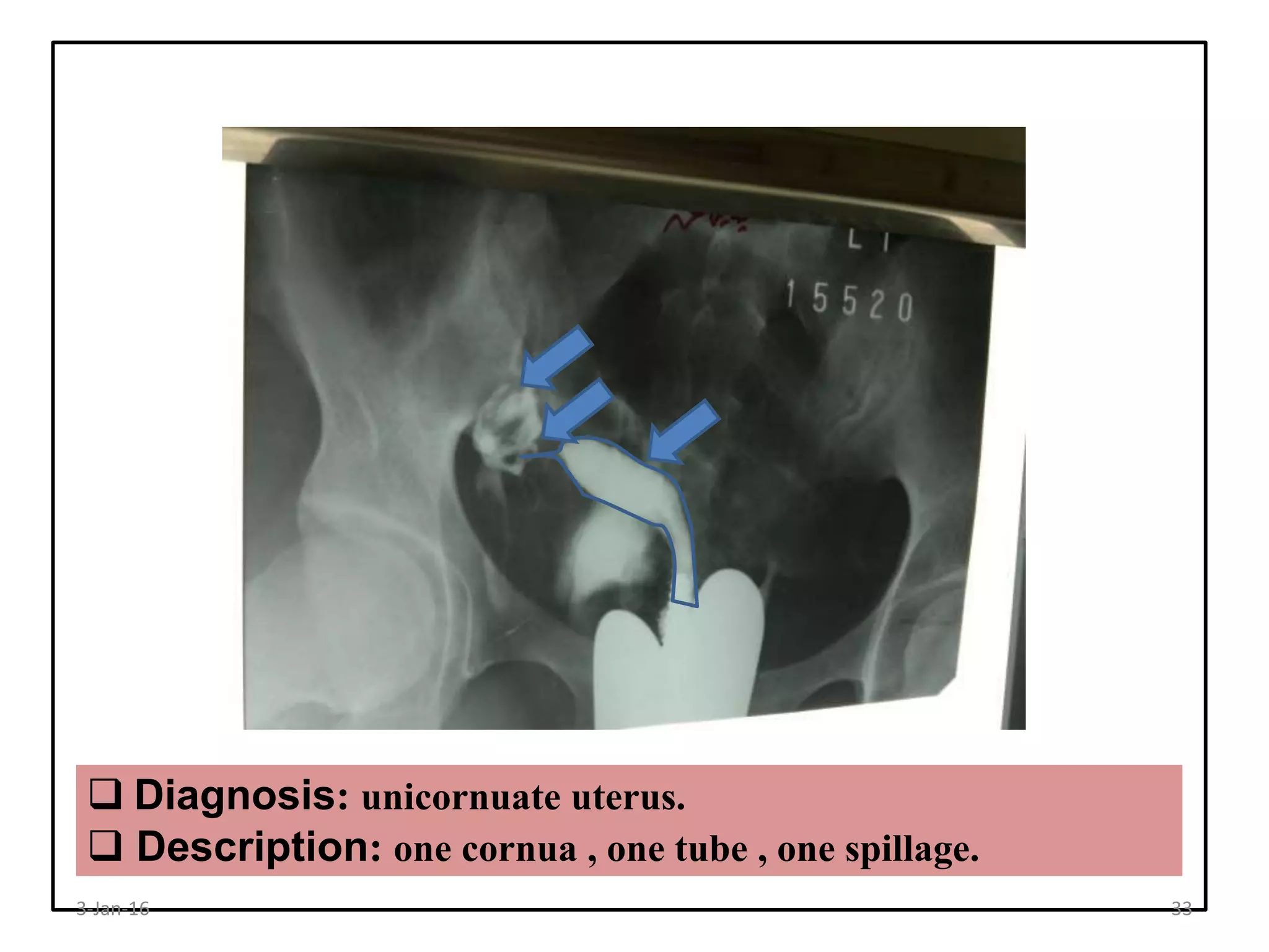 Hysterosalpingography | PPTX