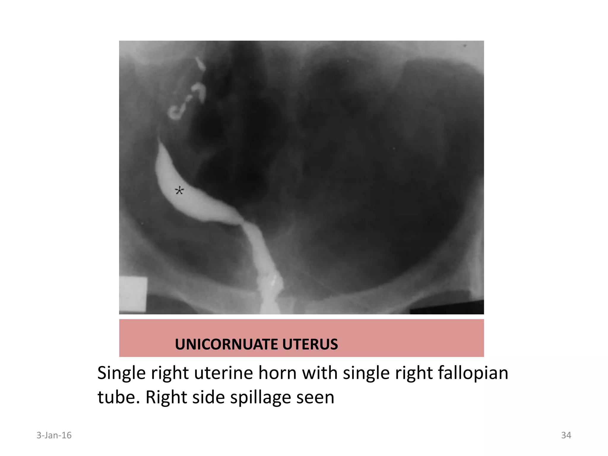 Hysterosalpingography | PPTX