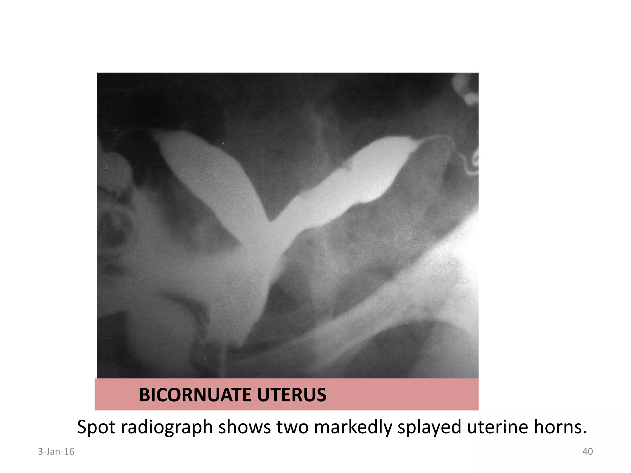 Hysterosalpingography | PPTX