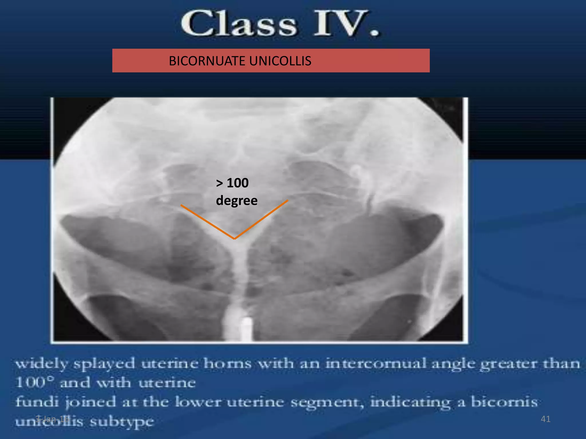Hysterosalpingography | PPTX