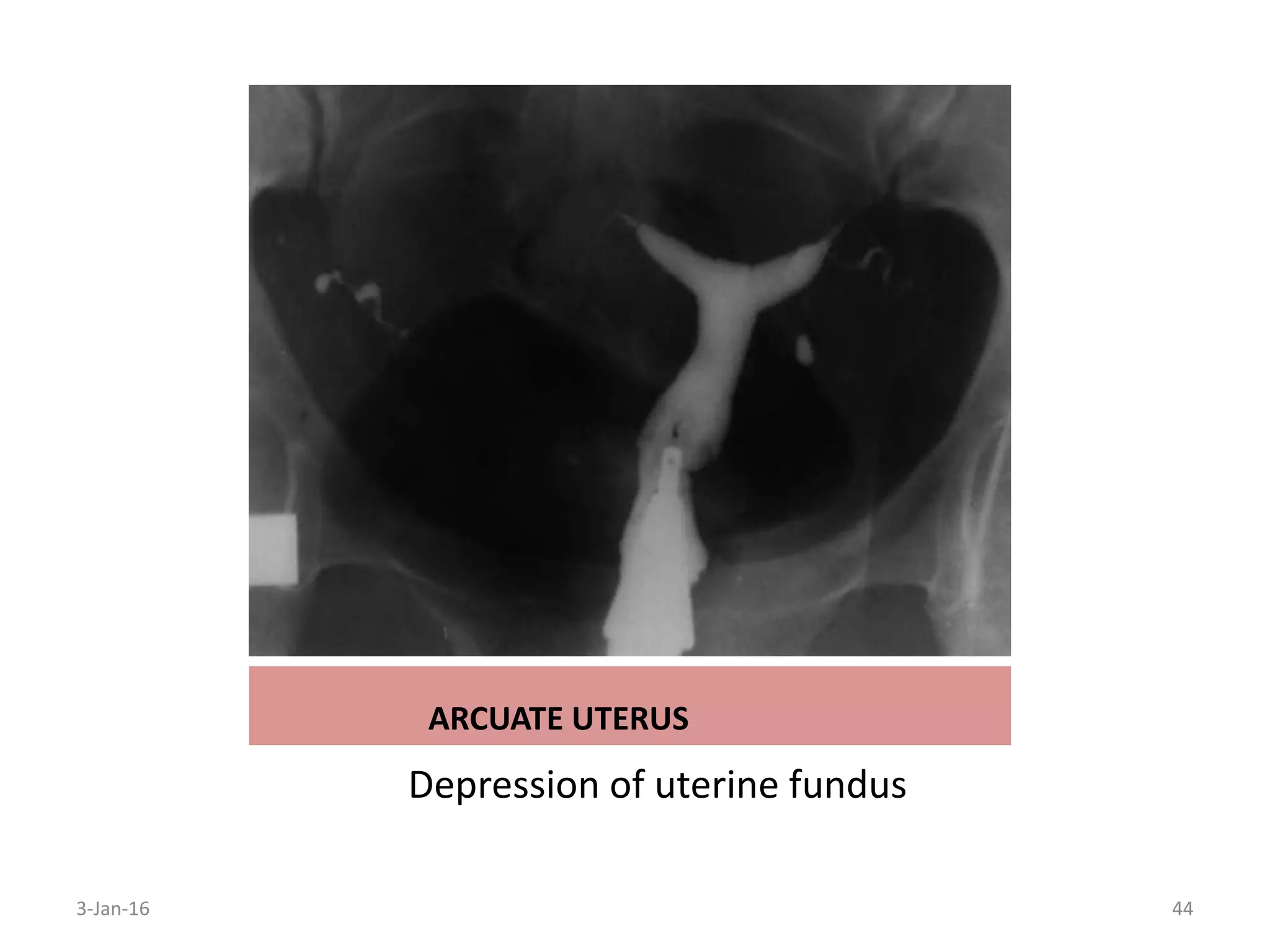 Hysterosalpingography | PPTX
