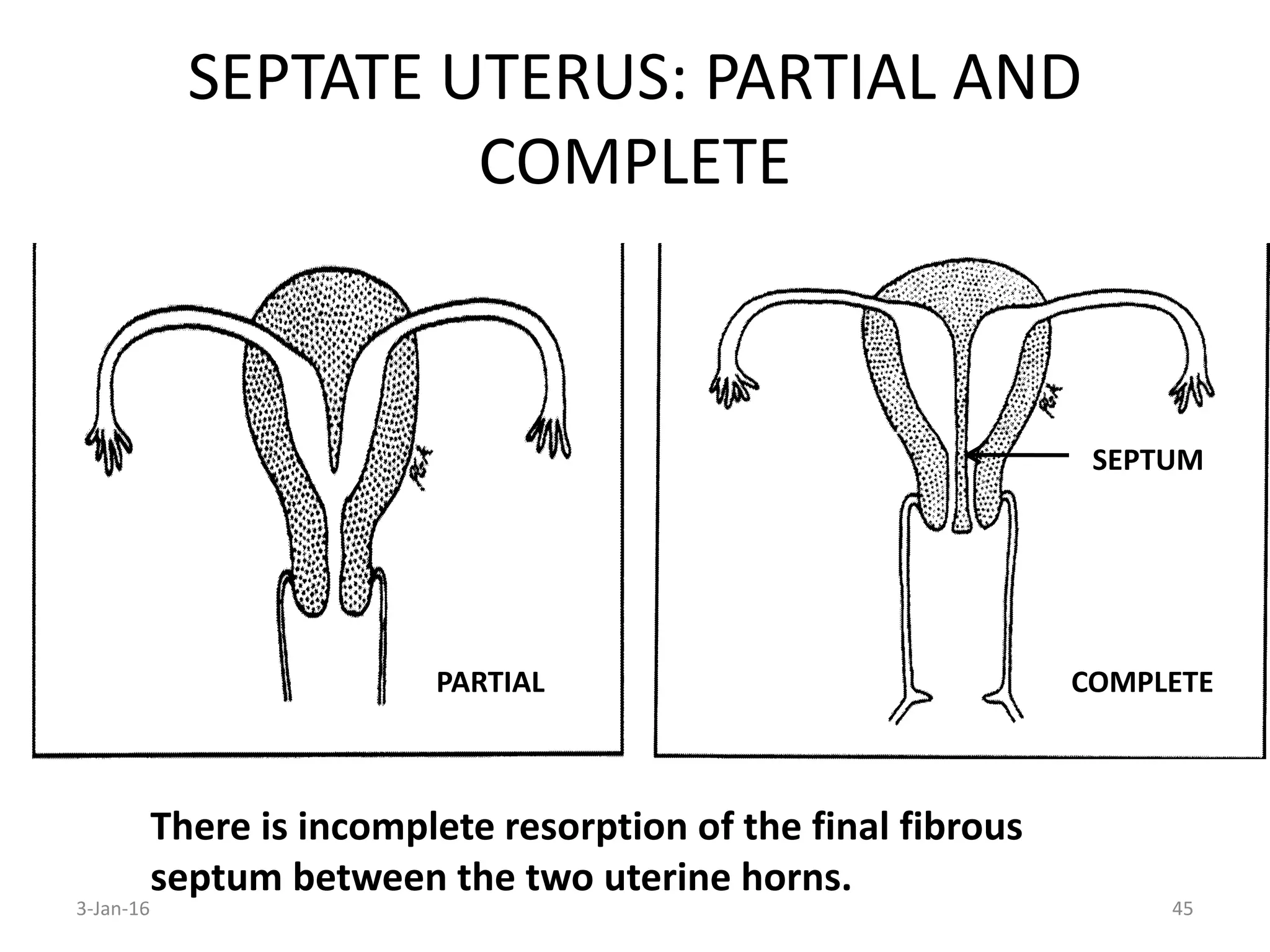 Hysterosalpingography | PPTX