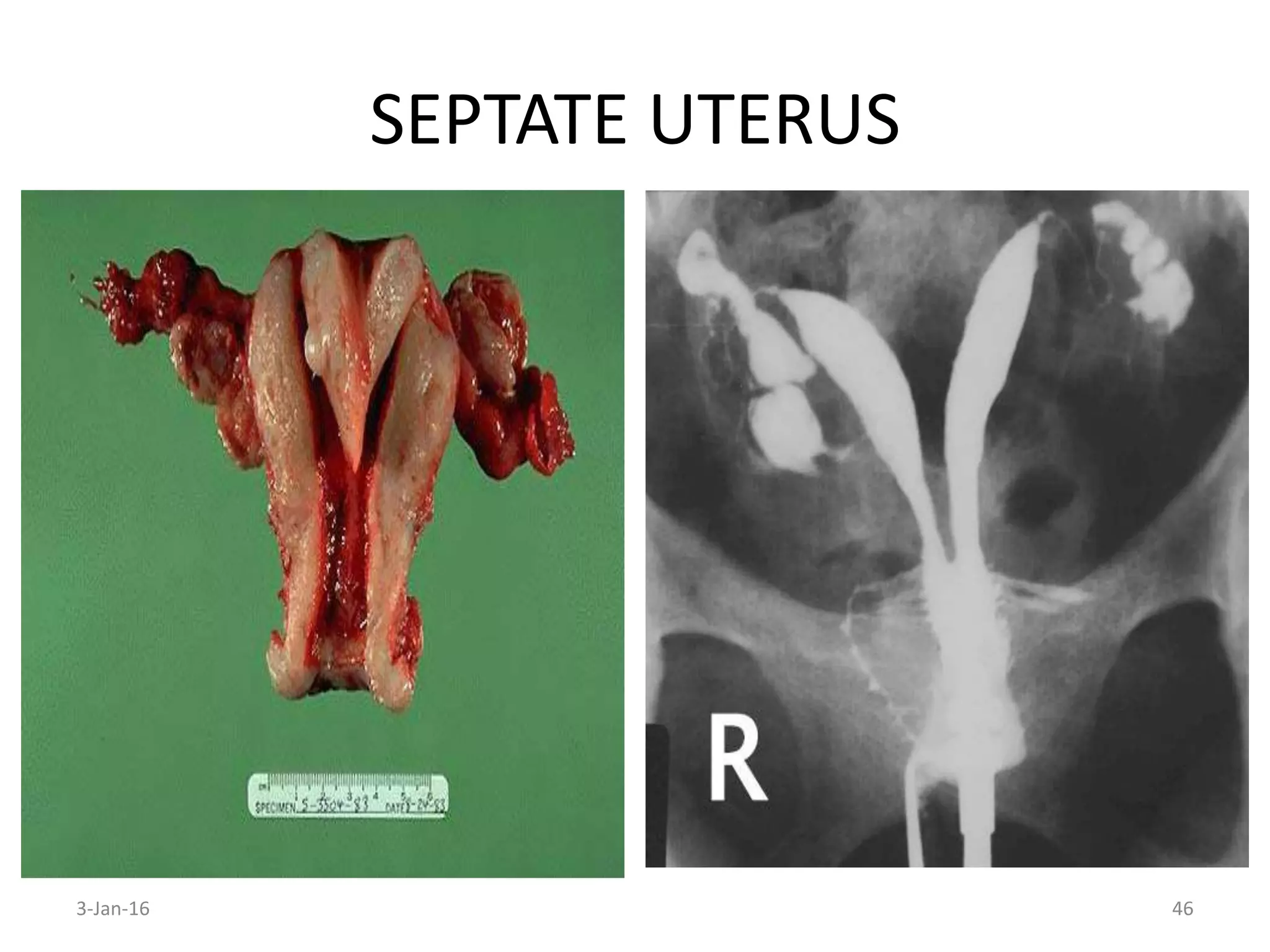 Hysterosalpingography | PPTX