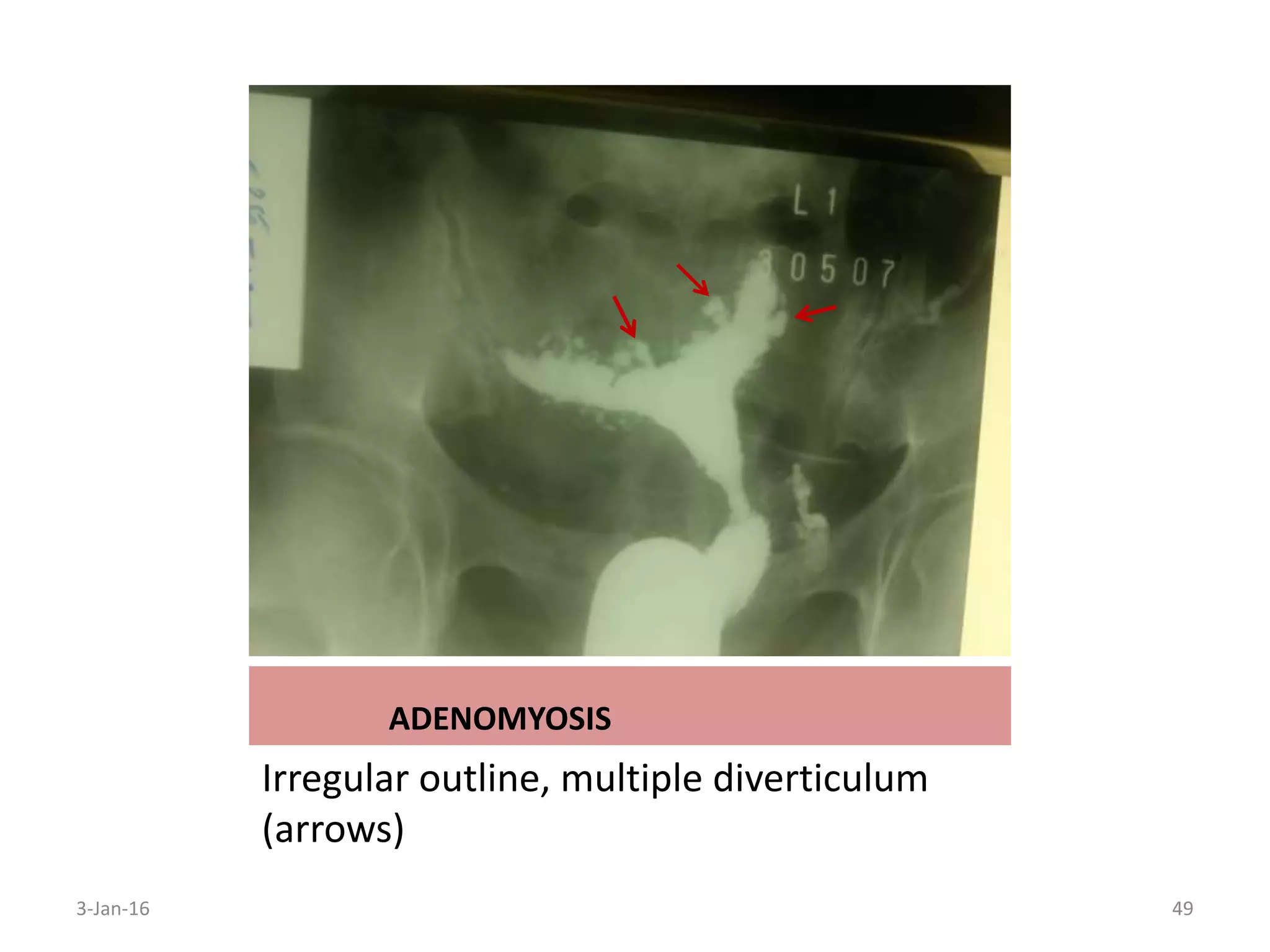 Hysterosalpingography | PPTX