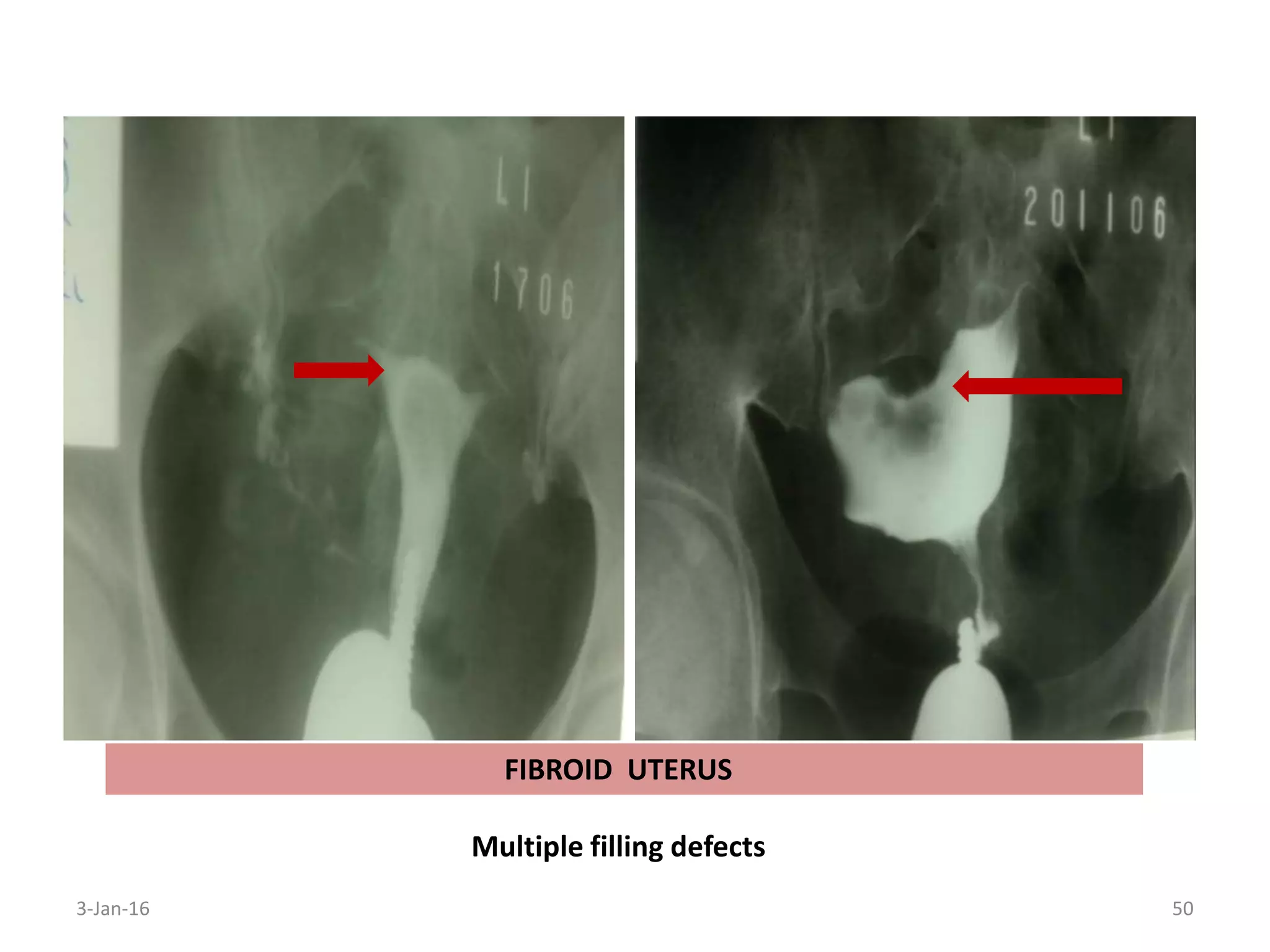 Hysterosalpingography | PPTX