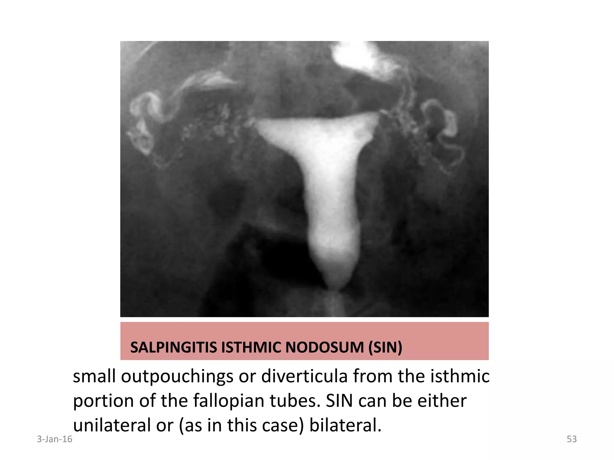 Hysterosalpingography | PPTX