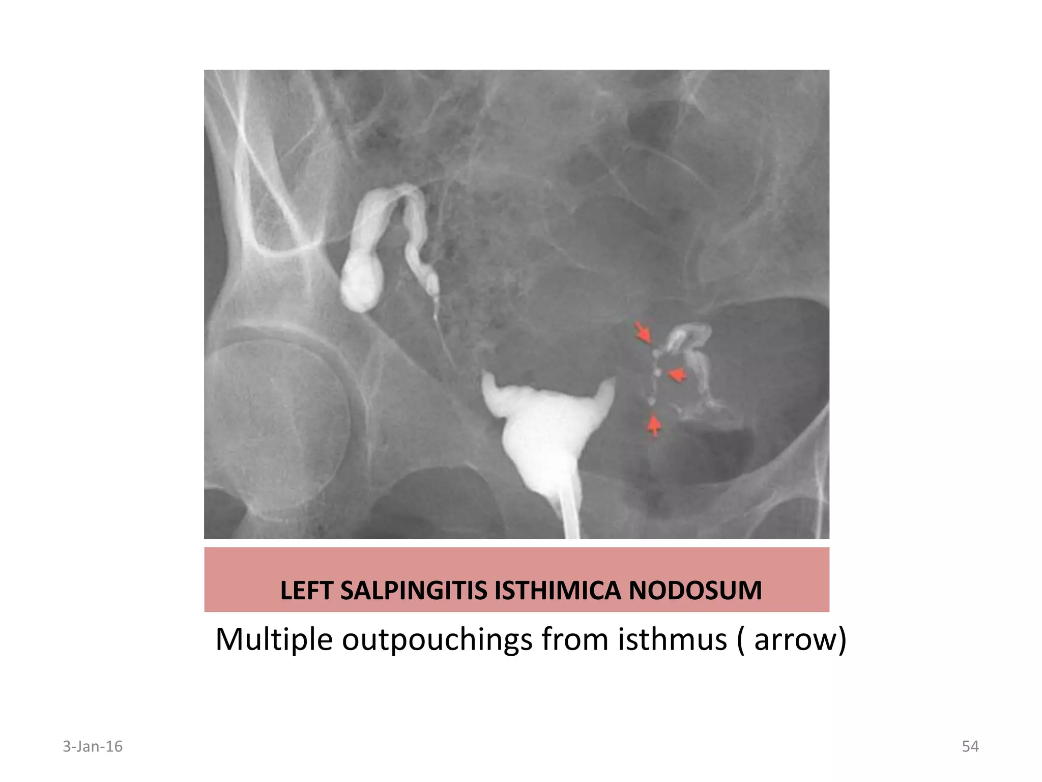 Hysterosalpingography | PPTX