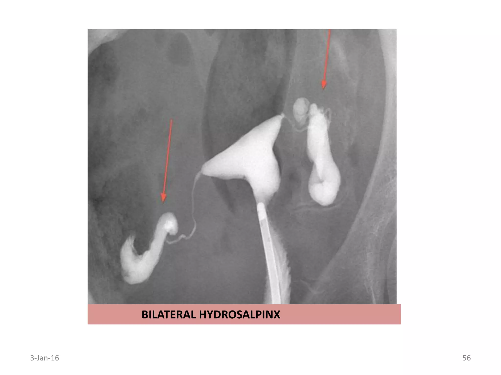 Hysterosalpingography | PPTX