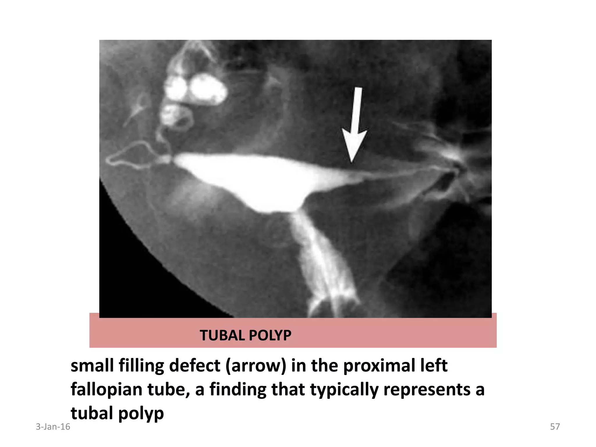 Hysterosalpingography | PPTX