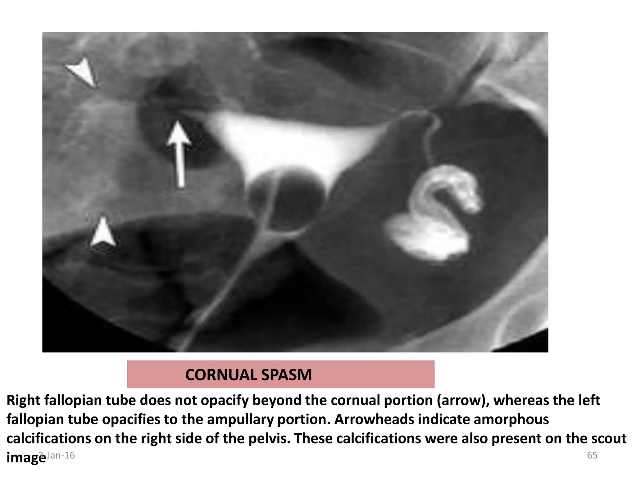 Hysterosalpingography | PPTX