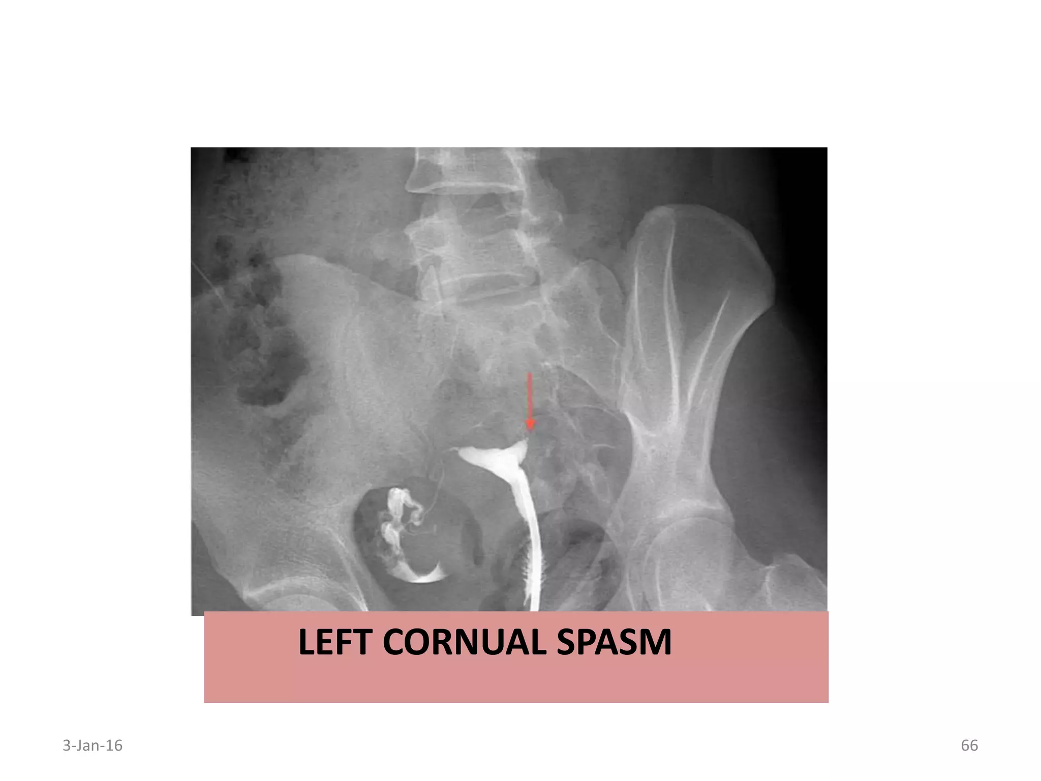 Hysterosalpingography | PPTX