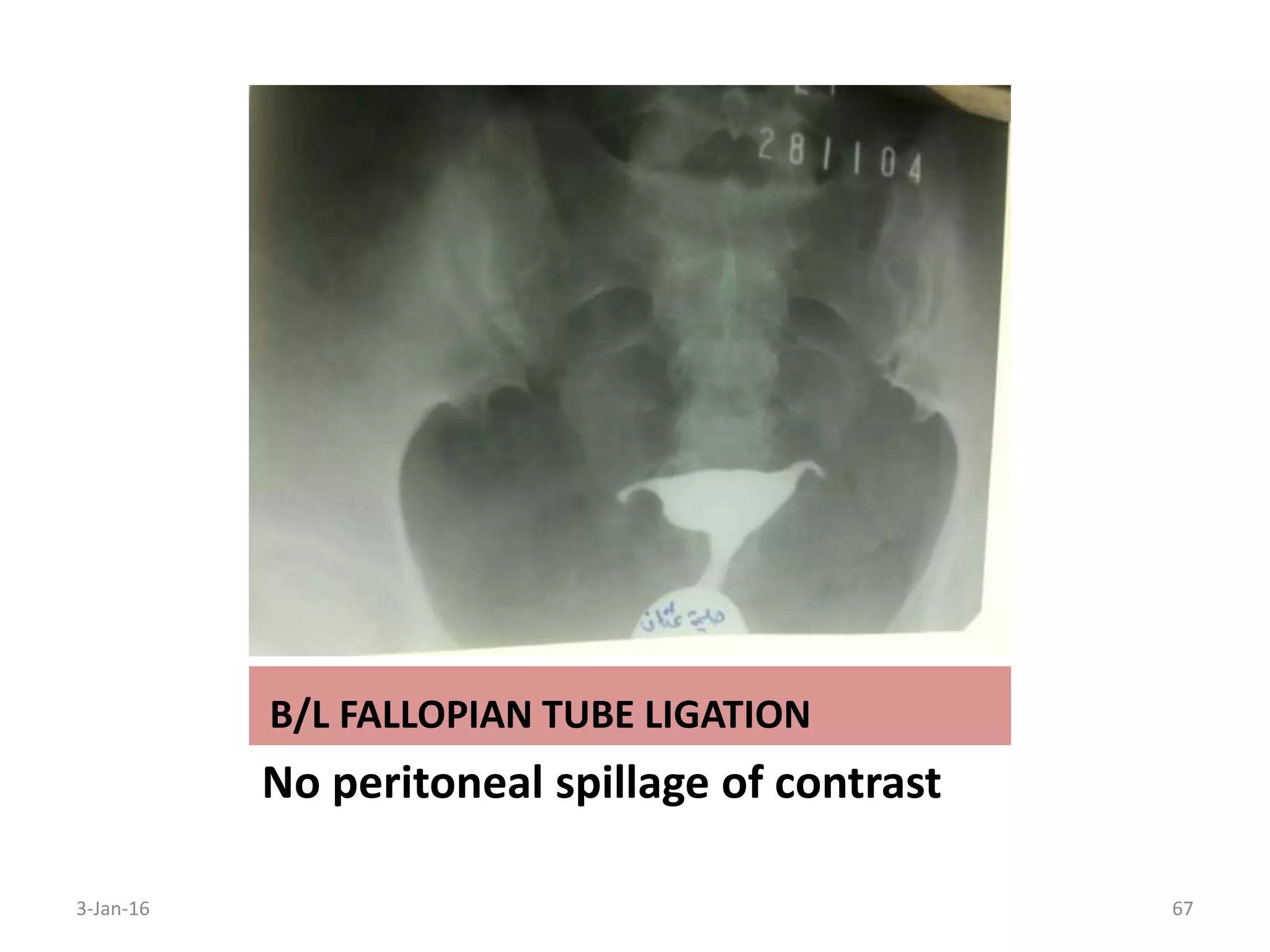 Hysterosalpingography | PPTX