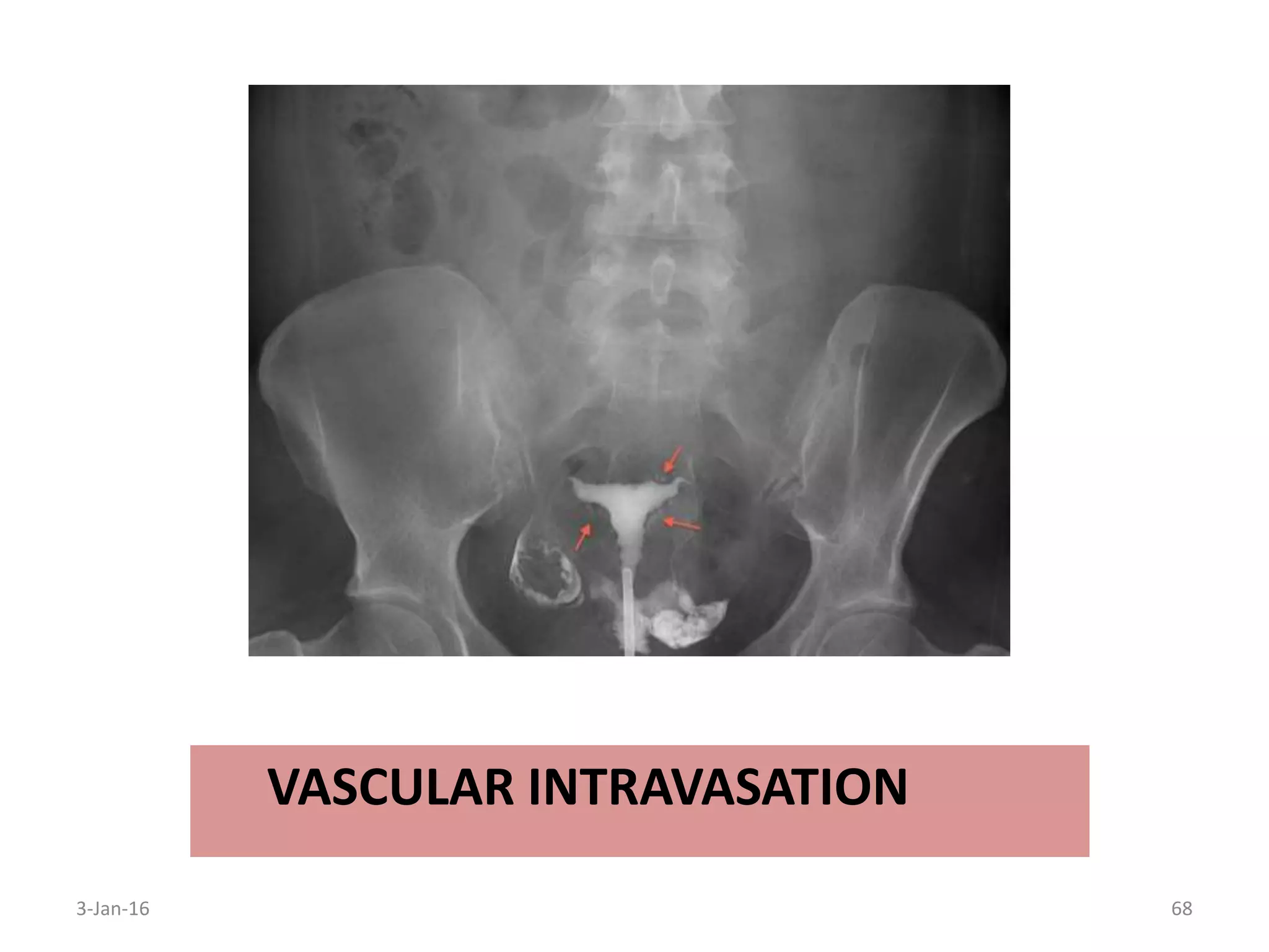 Hysterosalpingography | PPTX
