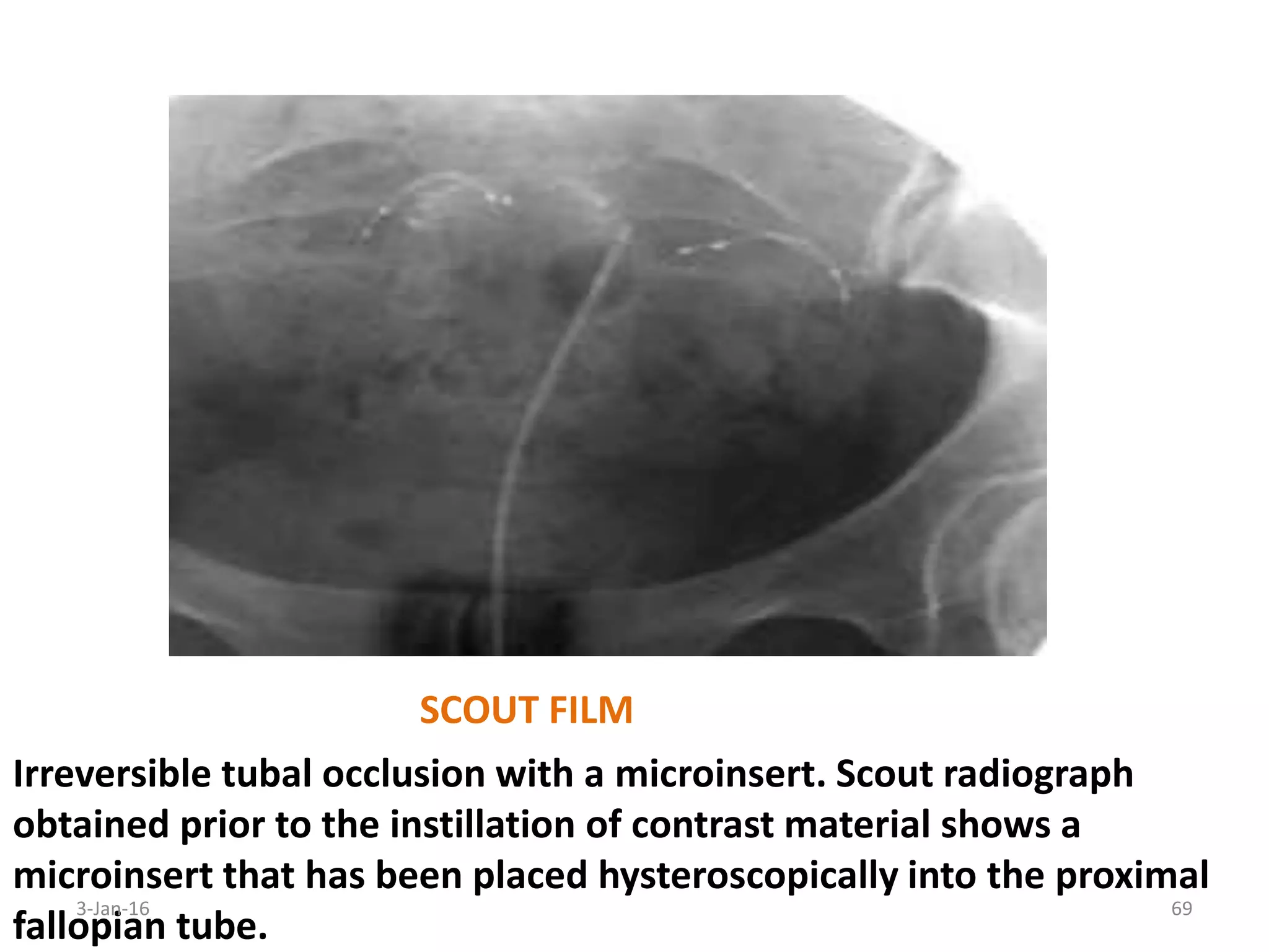 Hysterosalpingography | PPTX